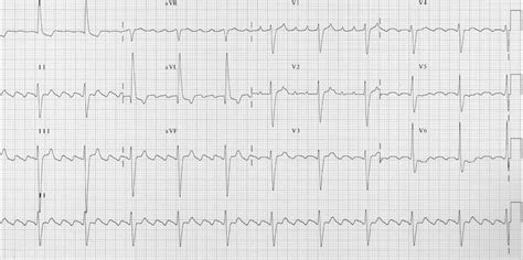 Atrial Flutter • Litfl • Ecg Library Diagnosis