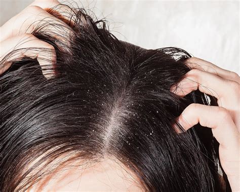 Scalp Exfoliation How To How Often And Diy Scalp Scrub Recipes