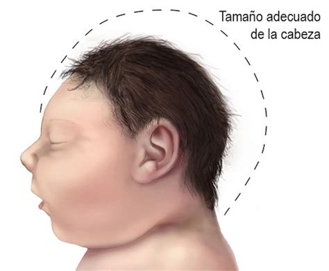¿qué Es La Microcefalia Causas Diagnóstico Tratamiento