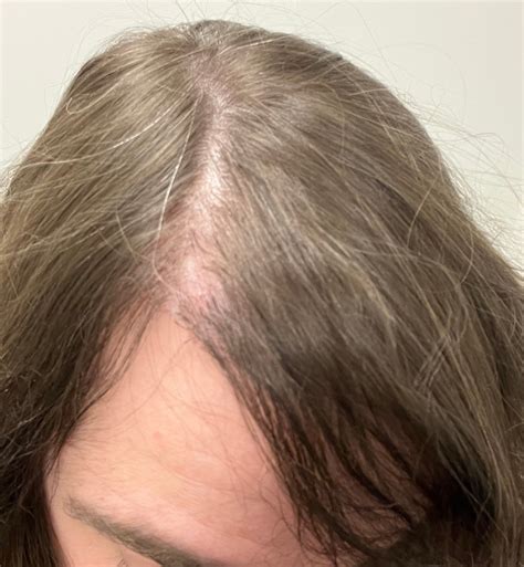 2ddr Best Product For Hair Loss 2 Deoxy D Ribose 2ddr Gel