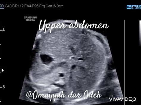 Video Dr Anish Choudhary On Linkedin Every Fetal Heart Evaluation According To The Recent