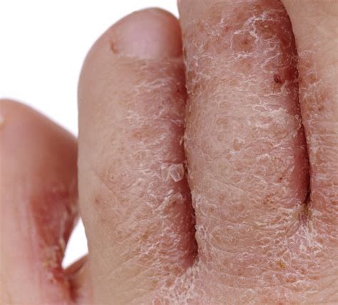 Акримиколь крем 2 — противогрибковое средство от грибковых инфекций кожи