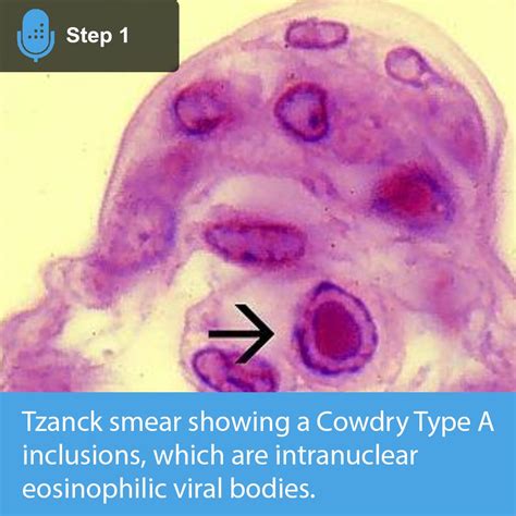 Cowdry Type A Intranuclear Inclusion Bodies