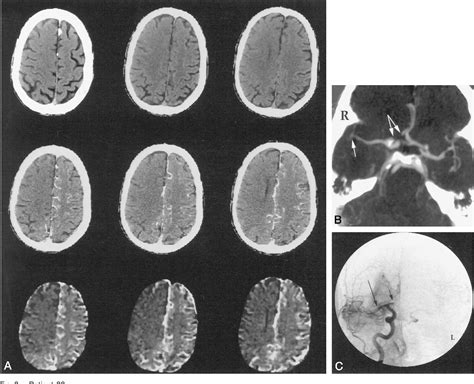 Figure 1 From Three Dimensional Functional Ct Early Anatomy In
