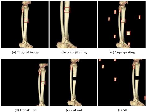 Interpretable Multi Label Classification For Tibiofibula Fracture 2d Ct
