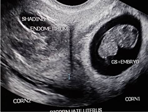 Bicornuate Uterus Ultrasound Spontaneous Twin Pregnancy In Uterus