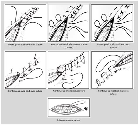 What Is A Continuous Suture At Robert Towner Blog