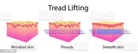 스레드 해제 벡터 일러스트 레이 션 및 피부 세포 효과 후 하기 전에 건강관리와 의술에 대한 스톡 벡터 아트 및 기타 이미지 건강관리와 의술 깨끗한 매끄러운 Istock