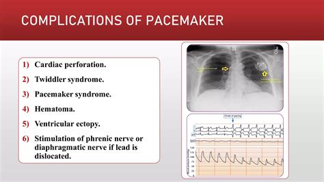 Pacemaker Pdf