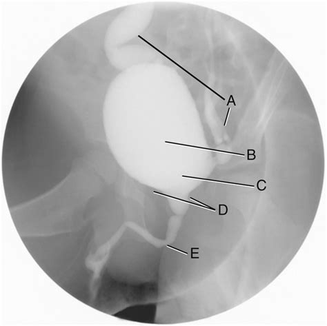 Voiding Cystourethrogram Rpo Male Diagram Quizlet