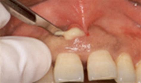 Ultimate Guide To Dental Abscess Symptoms Treatments Self Care And More