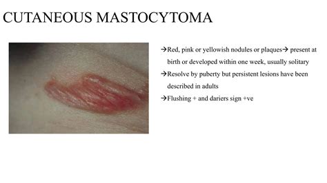 Cutaneous Mastocytosispptx Manifestations And Management Ppt