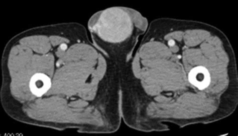 Contrast Enhanced Computed Tomography Revealed A Right Testicular Tumor