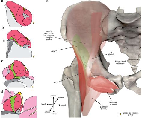 Figure 6 From Pericapsular Nerve Group Block And Iliopsoas Plane Block A Scoping Review Of