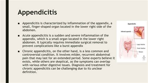 Acute Appendicitis Pptx