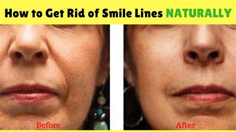 How To Fix Deep Smile Lines At Katie Felton Blog