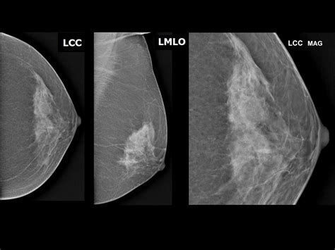 Atlas Of Breast Cancer Early Detection