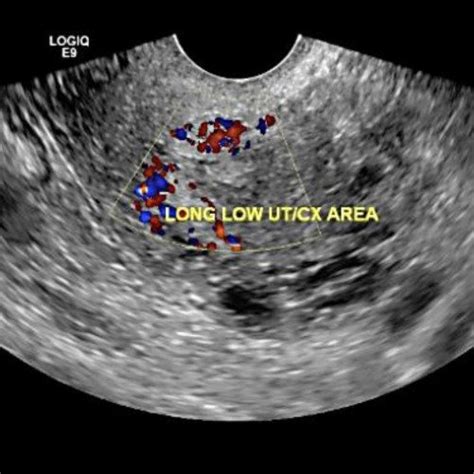 Angiography Following Gelfoam Embolization Of The Internal Iliac