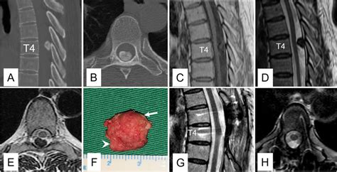 Ct Bone Window Ab Displayed An Intraspinal Tumor With High And