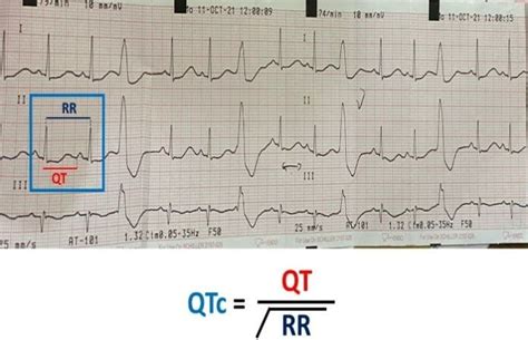 Bazetts Formula For Measurement The Qtc Interval Download Scientific Diagram