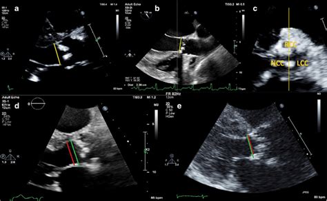 How To Measure Lvot Diameter Echo At Stan Denham Blog