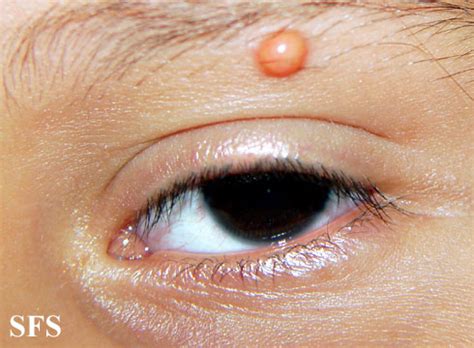 Juvenile Xanthogranuloma Wikidoc