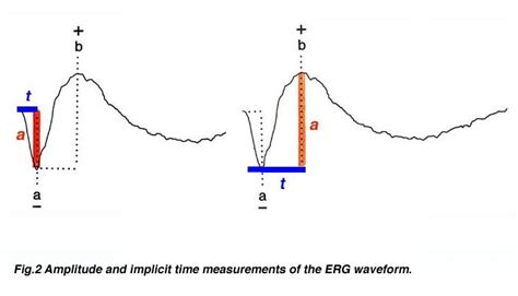 The Electroretinogram And Electro Oculogram Clinical Applications By