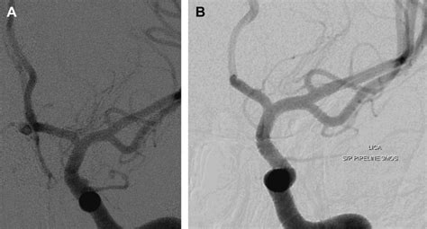 Treatment Of Blister Like Aneurysms With The Pipeline Embolization Device Neurosurgery Blog