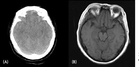 Figure 1 From Reversible Diffuse Brain Edema In Acute Encephalopathy