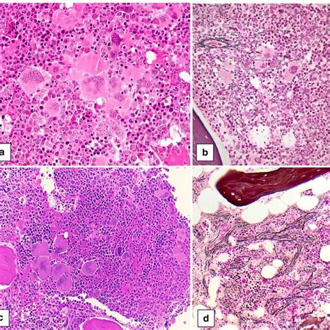 Bone Marrow Biopsy Of A 9 Year Old Girl With Polycythemia Vera In