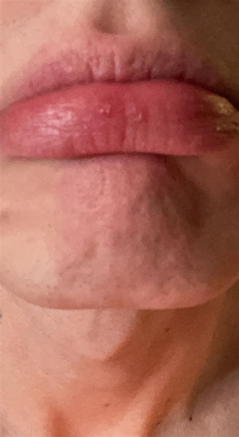 Cold Sores And Chapped Lip Remedy Usually Have The Dryest Lips In