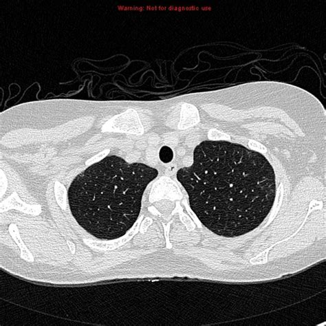 Diffuse Interstitial Lung Disease Pacs