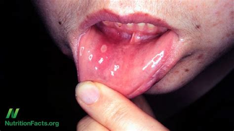 Apthous Ulcer Mystery Solved Canker Sore Ulcers Dairy Free Diet