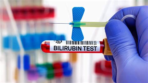 What Is A Dangerous Level Of Bilirubin In Adults Waykup