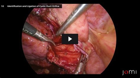 Laparoscopic Subtotal Fenestrating Cholecystectomy In A Cirrhotic Patient Journal Of Medical