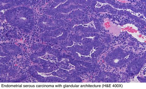 Pathology Outlines Serous Carcinoma