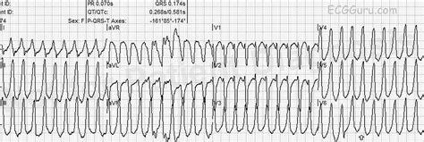 Vt Ecg Guru Instructor Resources