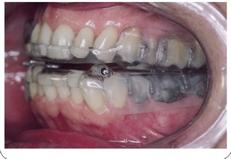 Mandibular Advancement Splint Wikipedia 40 Off