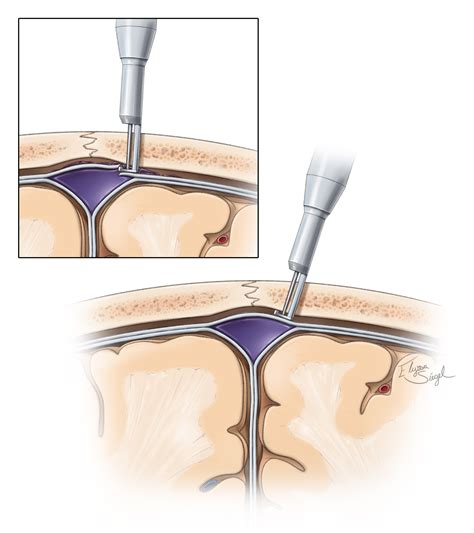 Burr Holes Post Op Care Having A Burr Hole Procedure Sjcxy