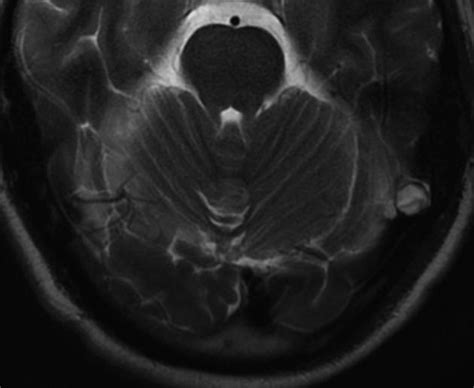 Arachnoid Granulation Pacs