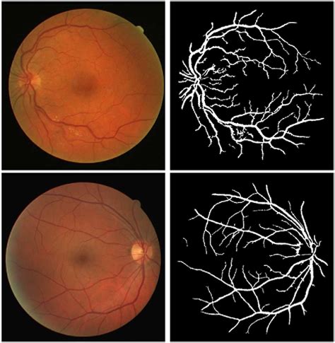 Figure 1 From Automatic Retinal Vessel Extraction Based On Directional Mathematical Morphology