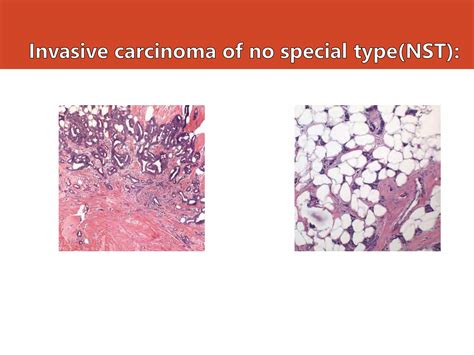 Classification Breast Tumour Pptx