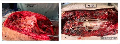 Intraoperative View Before And After Vertebrectomy And Spinal