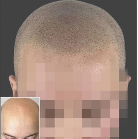 Scalp Micropigmentation Clinic In Cincinnati Scalp Micro Cincy