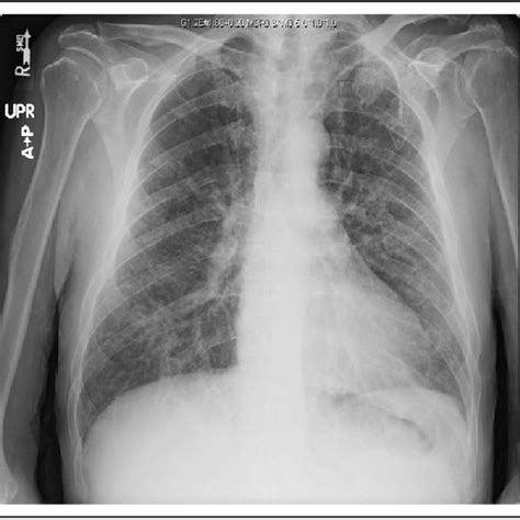 Macular Papular Rash With Associated Erythema On The Extensor Surface Download Scientific