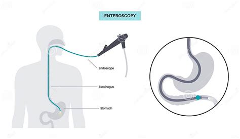 Esophagogastroduodenoscopy Medical Procedure Stock Vector