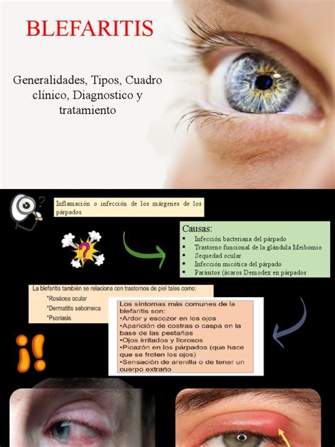 Blefaritis Generalidades Tipos Cuadro Clínico Diagnostico Y