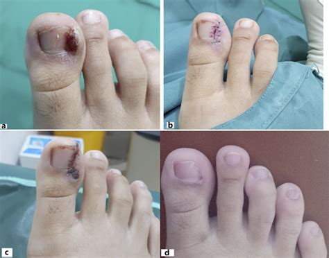 Matricectomy With Electrocautery As Therapy For Recurrent Ingrown