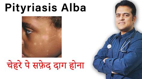 Treatment Of Pityriasis Alba Spots On Face How To Clean Marks Of