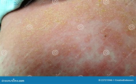 Contact Dermatitis With Small Vesicles And Streptococcal Cellulitis
